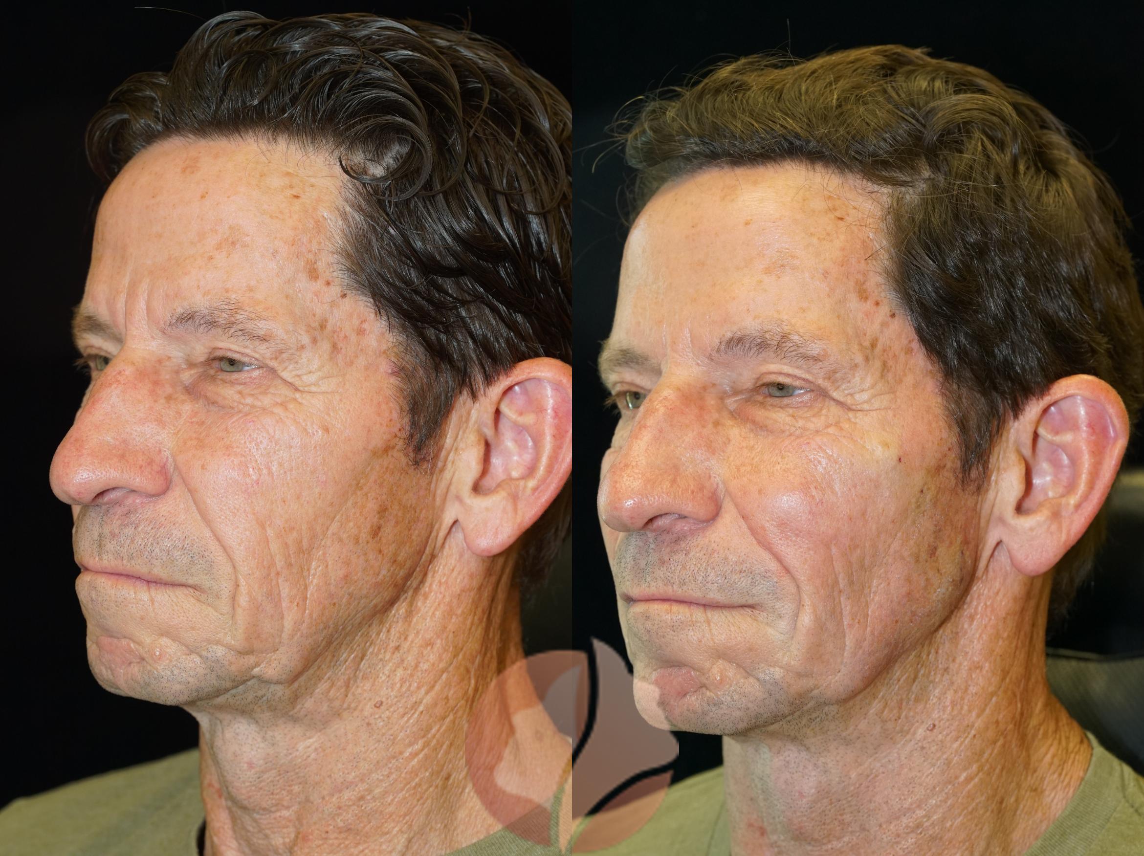 PDO Thread Lift Before and After Pictures Case 9 | Saratoga, CA ...